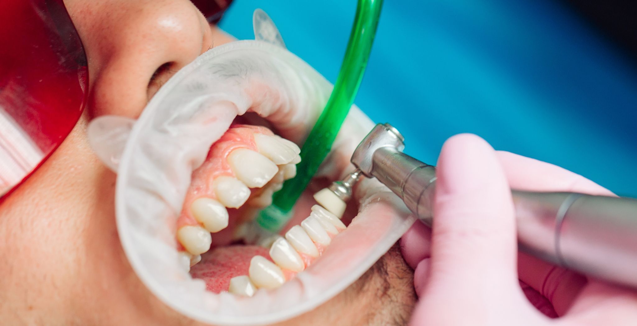 Teeth Cleaning: Why It’s Essential for Oral Health