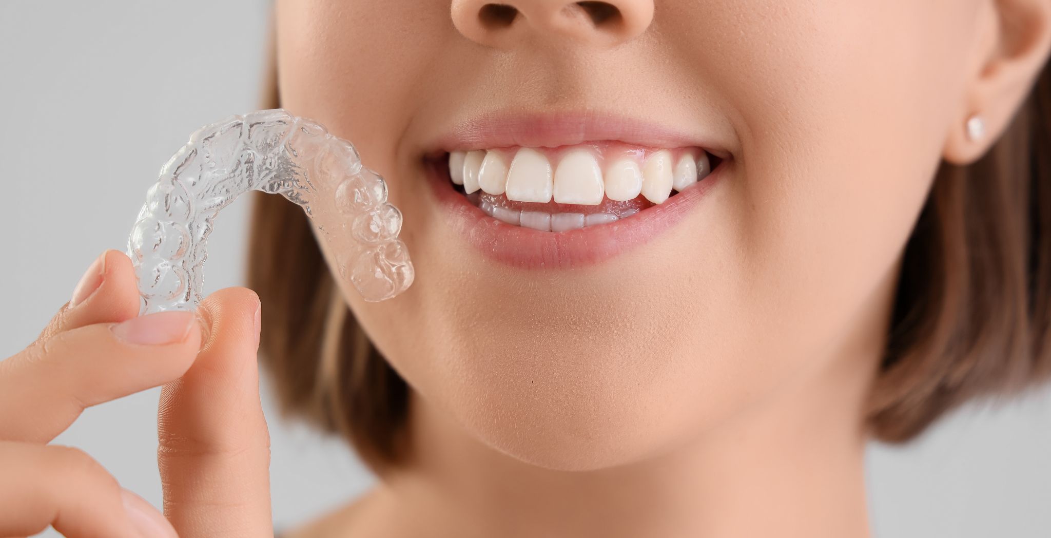 Overbite Correction: Solutions for a Better Bite - Simply Dental Chatswood